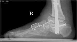 1. Stopa wydrążona i szpotawa - Ortopedia i Traumatologia